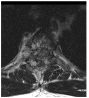 Aggressive Vertebral Body Hemangiomas Causing Spinal Cord Compression ...